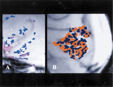 Detection Of Human Ocular Dominance Columns ODCs During Alternating Download Scientific