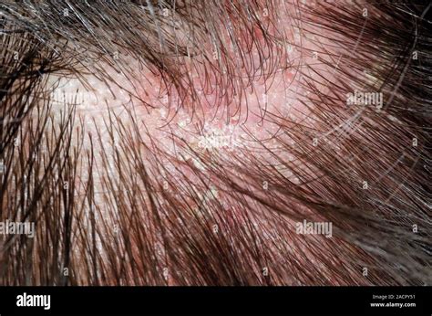 Red Flaky Patches Of Skin On The Scalp Of A 46 Year Old Male Patient Red Flaky Patches Of Skin On The Scalp Of A 46 Year Old Male Patient