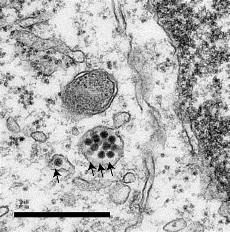 Archive Zika Infection May Be Masked By Other Viral Infections Uc