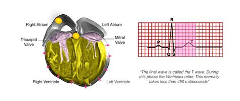 Atrial Flutter Ablation Melbourne Heart Rhythm
