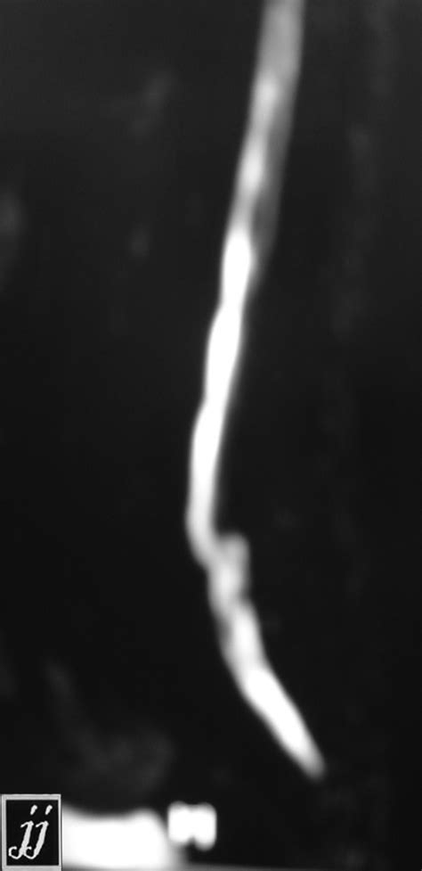 Antelisthesis Of L4 Radiopaedia