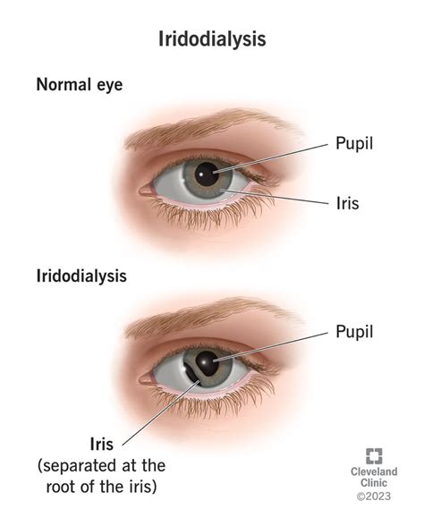 Split Pupil Syndrome Urrets Zavalia Syndrome After Implantable
