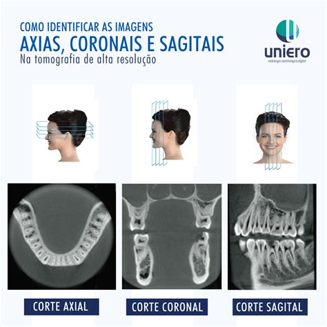 Cortes Sagital Coronal E Axial Retoedu