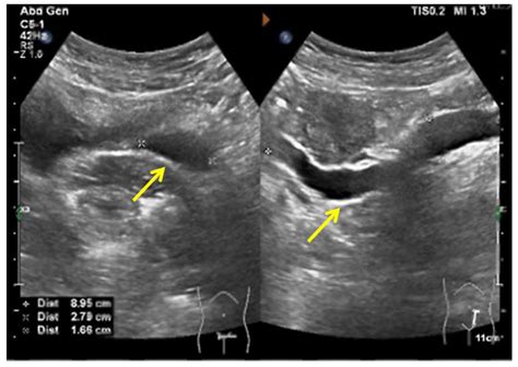 Ectopic Ureter