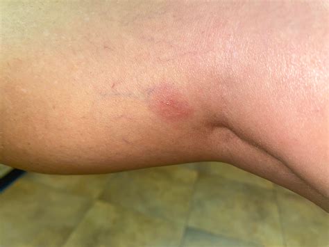 I Got Diagnosed With Shingles Is It Safe To Bandage The Blistersrash