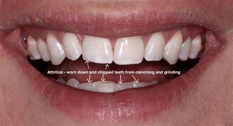 Teeth Wear Patterns At Ida Barrera Blog