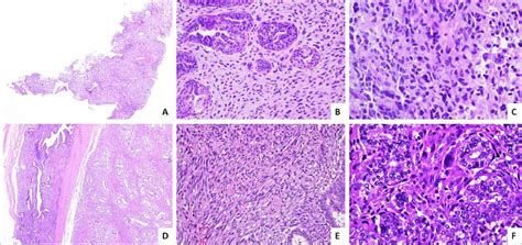 Malignant Phyllodes Tumor Of The Breast A Systematic Review