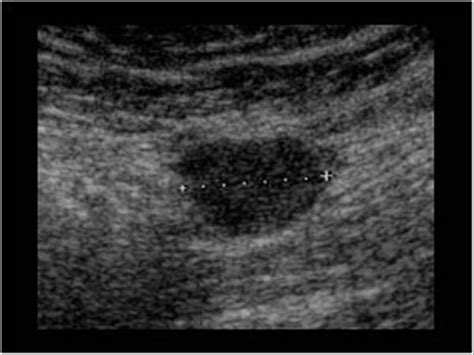 Abdomen And Retroperitoneum 1 5 Appendix Case 1 5 5 Mucocele Or Cystadenoma Of The Appendix