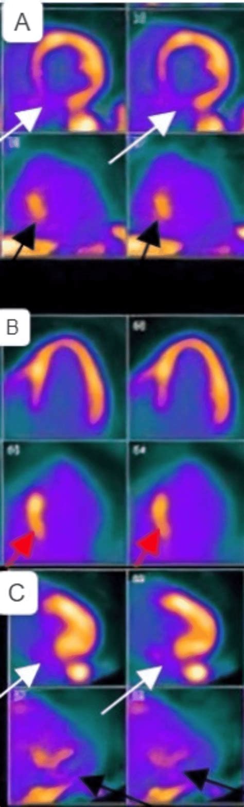 Petct Myocardial Perfusion Scan Showing A Severe Perfusion Defect In Download Scientific
