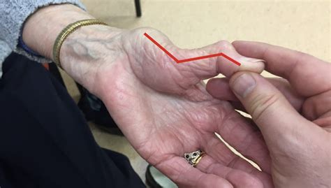 Physio Msk Z Shaped Thumb Deformity