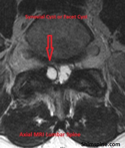 Synovial Cyst Lumbar Spine Removal Mapametawan