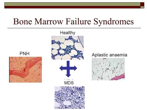 Hypoplastic Bone Marrow Syndromes Ppt