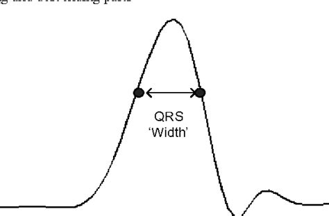 Figure 2 From Premature Ventricular Contraction Detection Using Swarm Based Support Vector