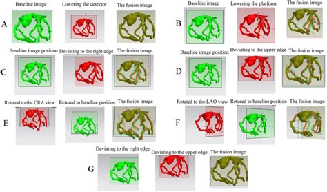 The Effects Of Common Dsa Gantry Movements On The Dsa Image Simulation Download Scientific