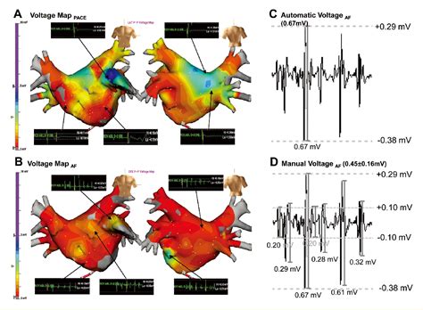Figure 1 From Characteristics Of Complex Fractionated Atrial Electrogram In The