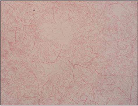 Microscopic Findings Showed Fusobacterium Nucleatum Long And Slender
