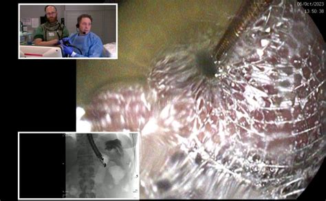 Michiel Bronswijk Md Febgh On Linkedin Eus Ercp Hepaticogastrostomy