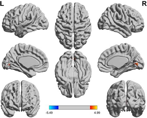 Figure 1 From Regional Homogeneity In Patients With Obsessive