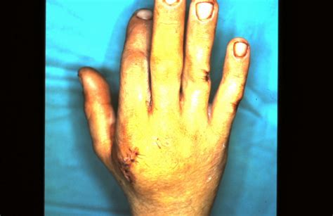 Repair Edc Eip The Hand Treatment Center New Jersey New York Hand Surgeon