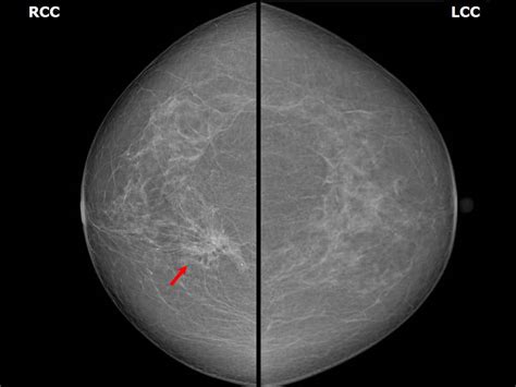 Atlas Of Breast Cancer Early Detection
