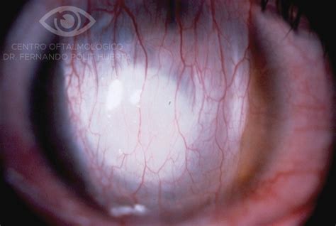 Recubrimiento Conjuntival Atlas De Oftalmología