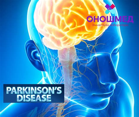Onoshmed Clinical Laboratory Паркинсоны өвчин нь допамин үүсгэдэг тархины эсүүд алдагдсанаас