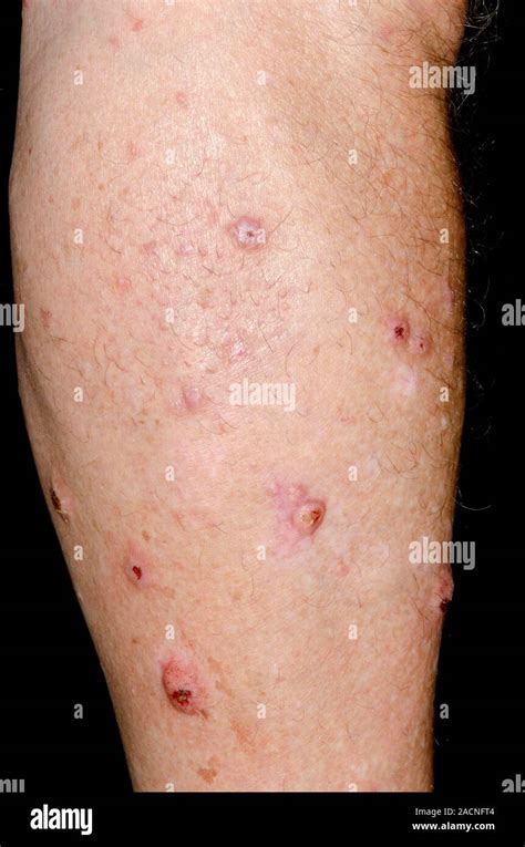 Dark Nodules On The Skin Of The Leg In An 84 Year Old Male Patient A Condition Known As Nodular