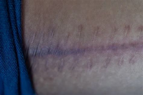 Scar Tissue Stock Images Search Stock Images On Everypixel