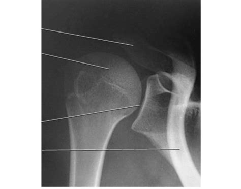 Grashey Shoulder Quiz