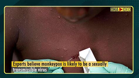 Monkeypox WHO Warns Virus Spreading In Sexual Networks Can The Virus Lead To Another Pandemic