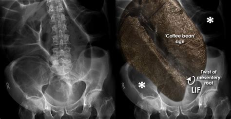 Sigmoid Colon Volvulus