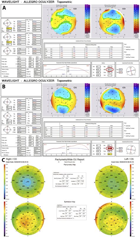 A And B Topometric Map Of The Right And Left Eye 7 Years Post Prk Of