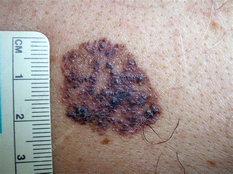 Basal Cell Carcinoma Stock Image C0570510 Science Photo Library