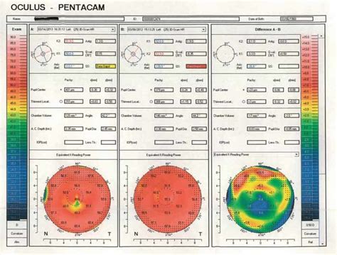 Pentacam Hr Comparative Topometric Map Of The Anterior Corneal
