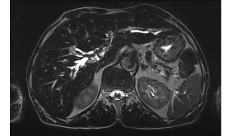 Mri Axial Cuts At The Level Of Hilum Showing Bilobar Ihbrd With The
