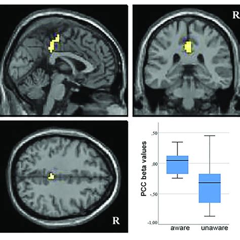 Group Analysis Fmri Results Areas Of Increased Differential Signal
