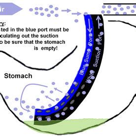 Properly Functioning NGT While Continuous Suction Is Applied To The Download Scientific