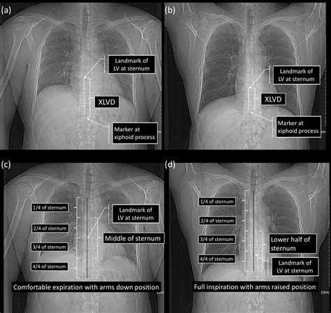 Xiphoid Process Of Sternum