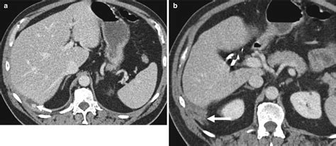 The Gallbladder Radiology Key