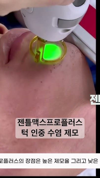 젠틀맥스프로플러스 남자 턱 인중 수염제모 시술동영상 20240911 수원 원스의원 남자제모 수염제모 수원남자제모 수원수염