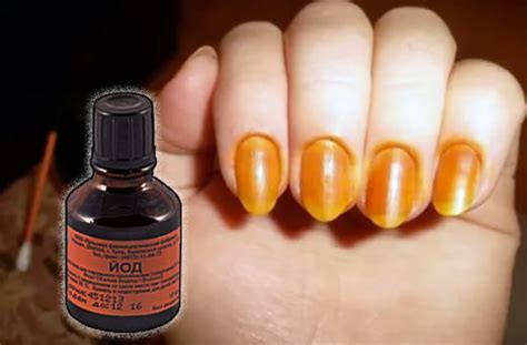 იოდის აბაზანა ფრჩხილების სოკოვანი ინფექციისგან ონიჰომიკოზისგან კვალსაც არ დატოვებს