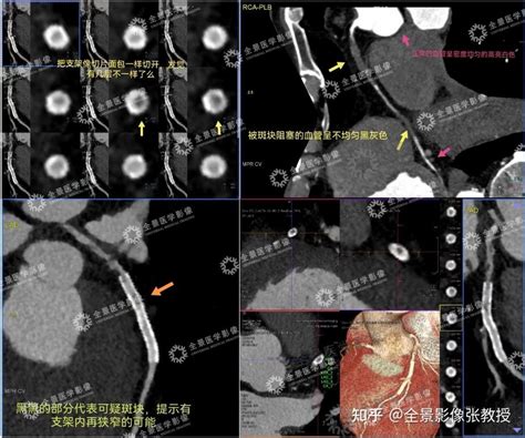 冠状动脉狭窄？心肌缺血？你需要知道的检查 知乎