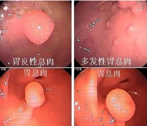 发现胃息肉，到底要不要切除？癌变患者幽门