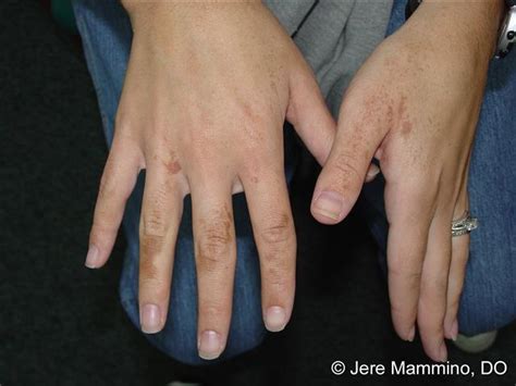 Phytophotodermatitis American Osteopathic College Of Dermatology Aocd