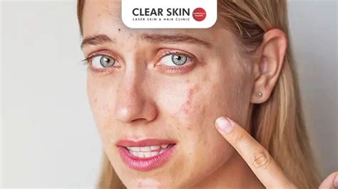 How To Remove Acne Scars Clear Skin
