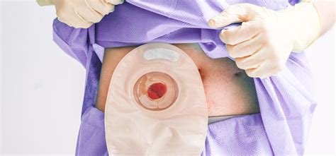 Understanding Colostomy Bags Types Uses Care Tips