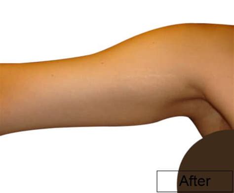 Body Skin Tightening RF Treatments For Home Silk N Lipo VS Silk N LIPO Official Seller