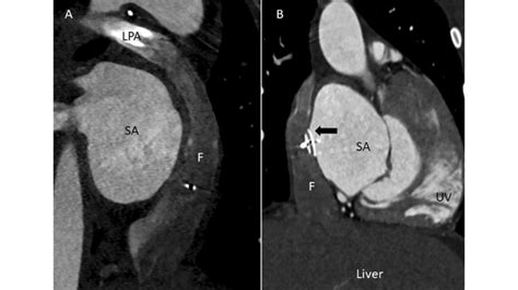 Cardiac Cta Curved Mpr With A Patent Fontan Graft To Lpa B Curved Download Scientific