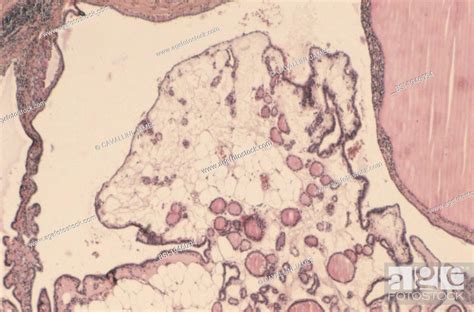 GOITER HISTOLOGY Stock Photo Picture And Rights Managed Image Pic BSI 1946094 Agefotostock