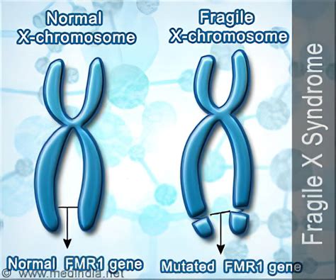 Fragile X Syndrome Inheritance